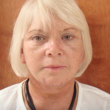 Facelift - Orlando, FL | Advanced Aesthetics