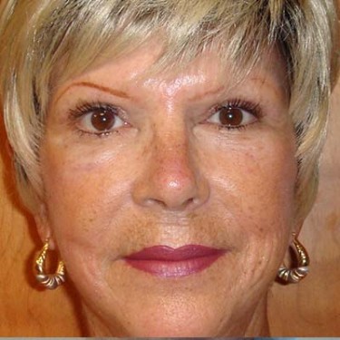 Facelift - Orlando, FL | Advanced Aesthetics